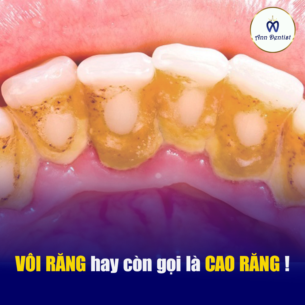 Cạo Vôi Răng Là Gì? Vôi Răng Có Ảnh Hưởng Như Thế Nào Đến Sức Khỏe Răng ...